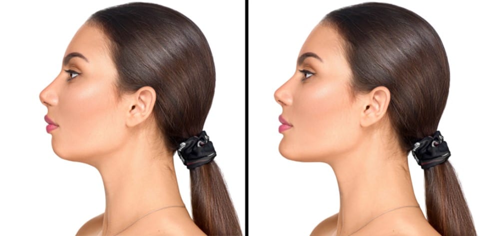 คางสั้น คางตัด คางถอย มีวิธีแก้ไขเพื่อเสริมคางให้ยาวได้อย่างไร